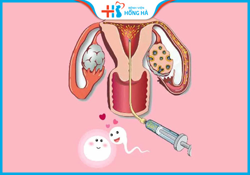 Bơm tinh trùng vào buồng tử cung IUI là gì? Quy trình như thế nào?