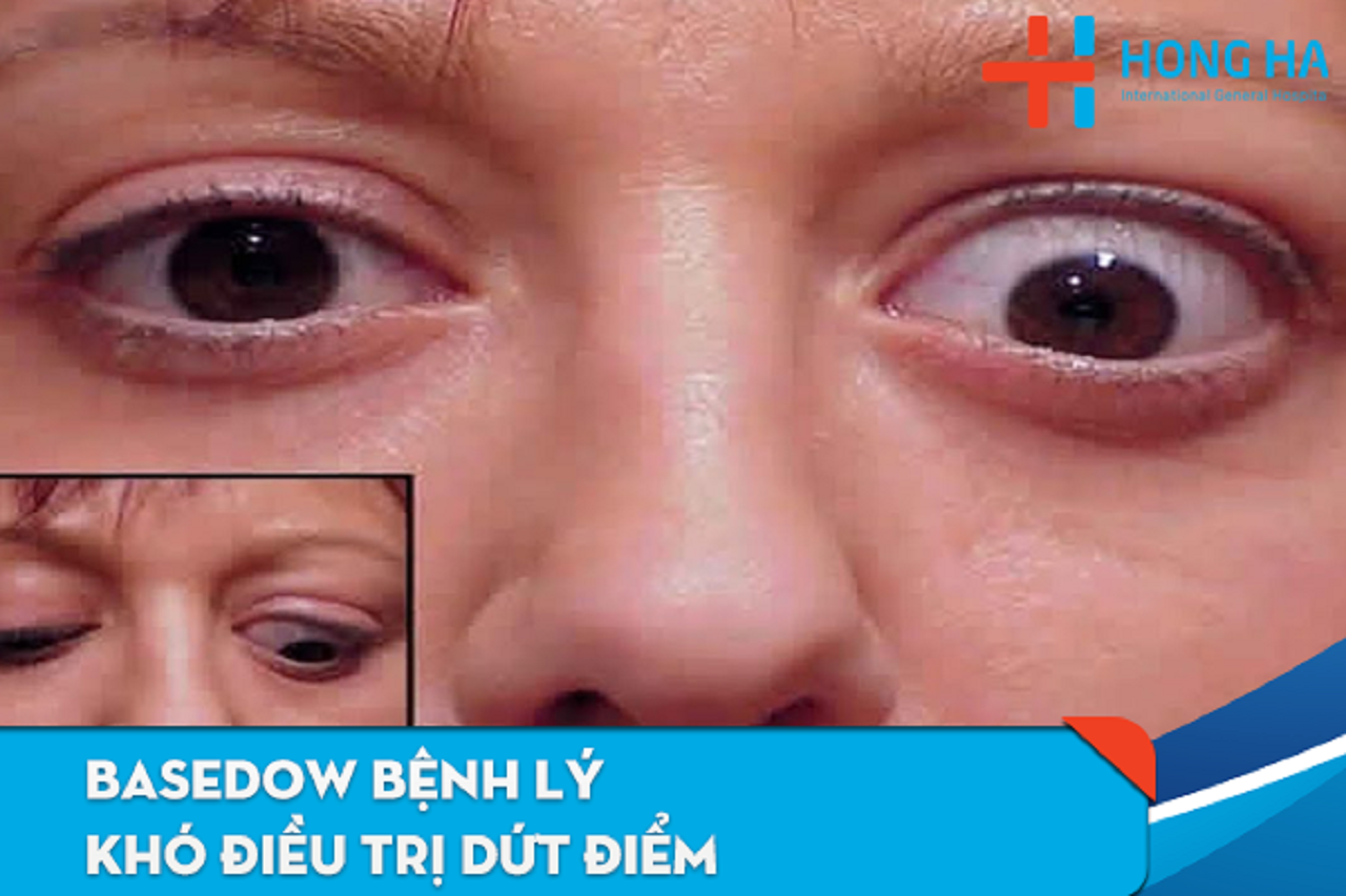 Hiểu rõ về bệnh basedow và phương pháp điều trị