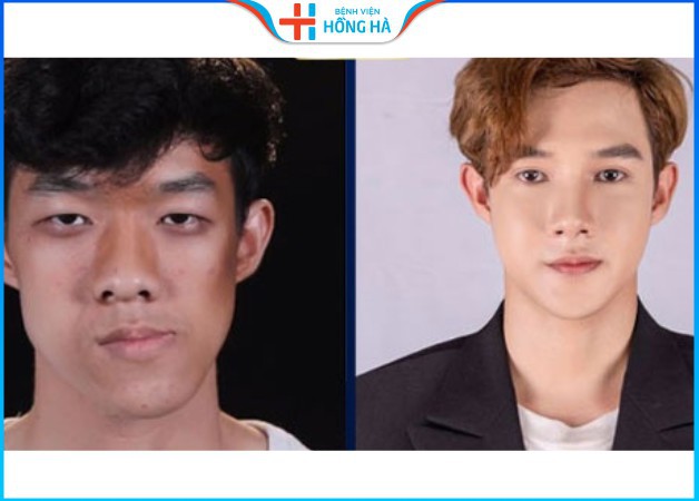 Mặt lệch là như thế nào? 6 Nguyên nhân và cách khắc phục