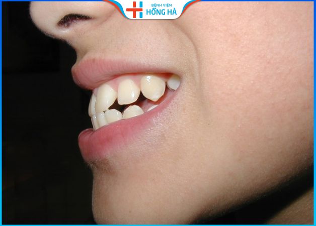 Chỉnh hàm răng hô thực hiện một lần duy nhất hiệu quả lâu dài