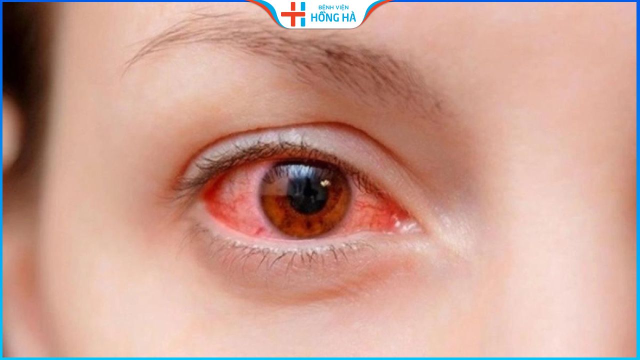 5 Cách chữa đau mắt đỏ nhanh nhất không phải ai cũng biết