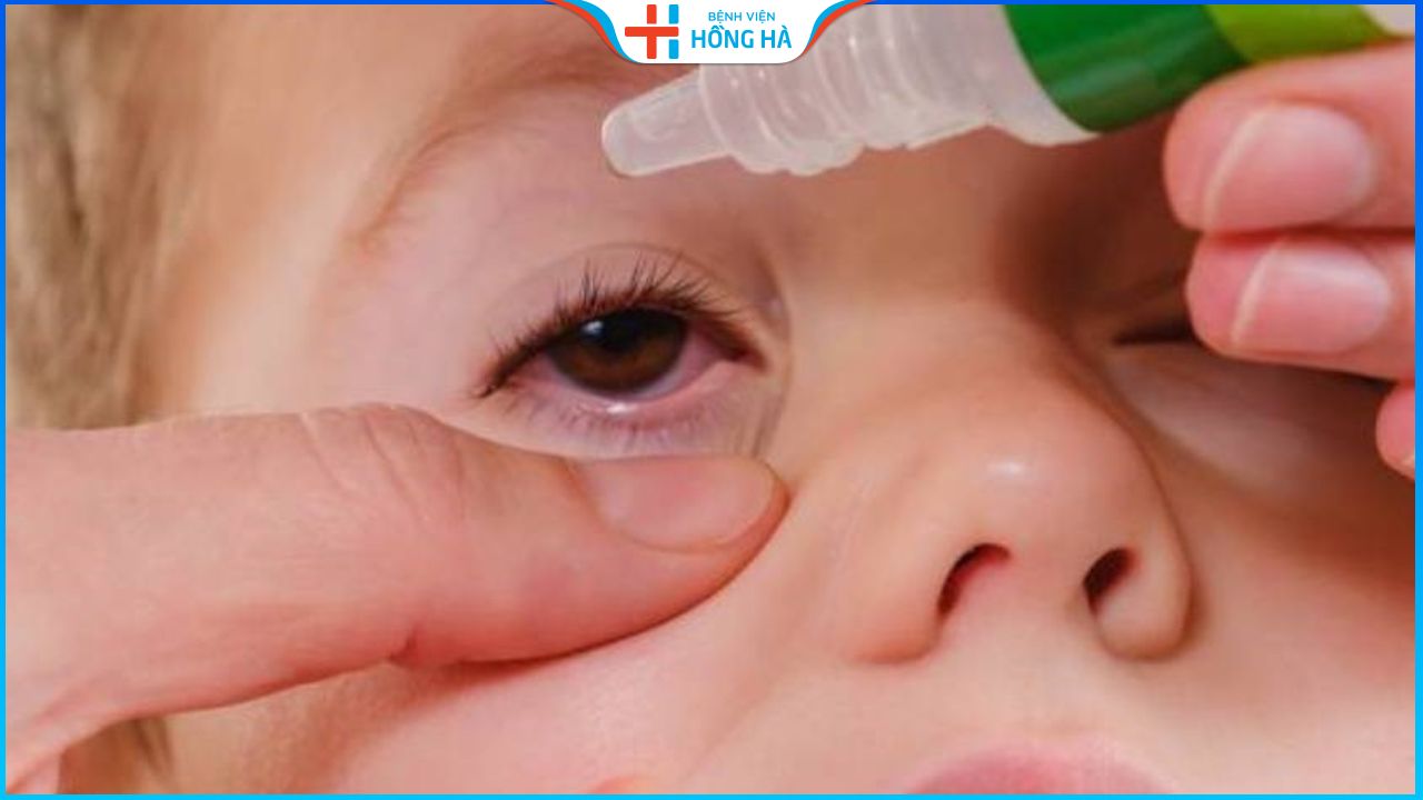 8 Loại thuốc nhỏ mắt trị đau mắt đỏ điều trị nhanh, hiệu quả